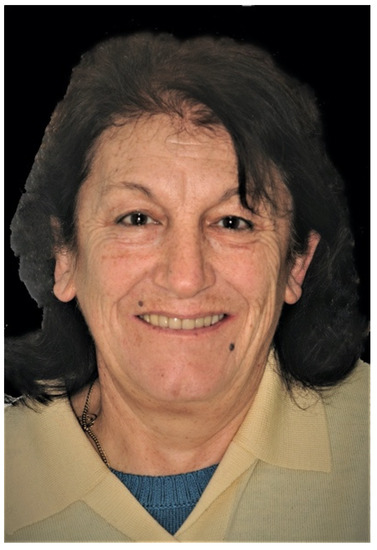 Implant-Supported Prosthetic Therapy of an Edentulous Patient: Clinical ...