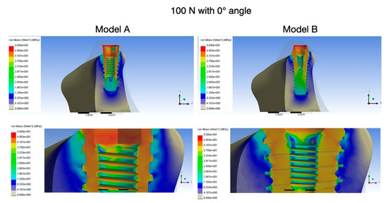 Finite Element Analysis of a New Dental Implant Design Optimized for ...