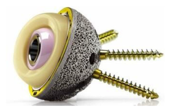 Preliminary Results of Total Hip Arthroplasty in Subjects at Risk for ...