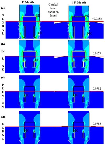 A Parametric Study on a Dental Implant Geometry Influence on Bone ...