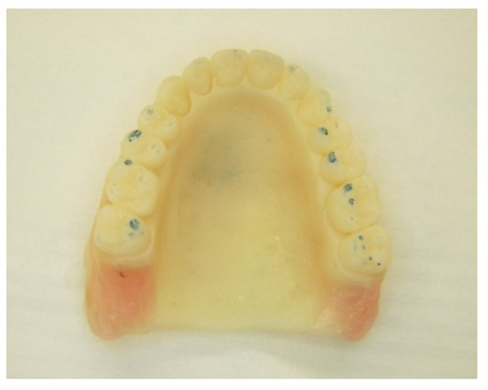Current Status of Digital Complete Dentures Technology