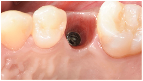 Implant Fracture: A Narrative Literature Review