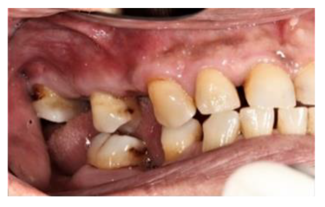 Construction of a Removable Partial Denture (RPD): Comparison between ...