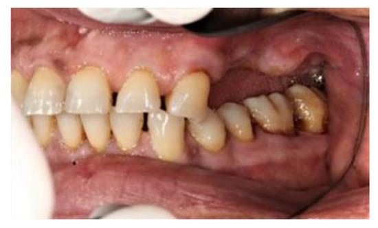Construction of a Removable Partial Denture (RPD): Comparison between ...