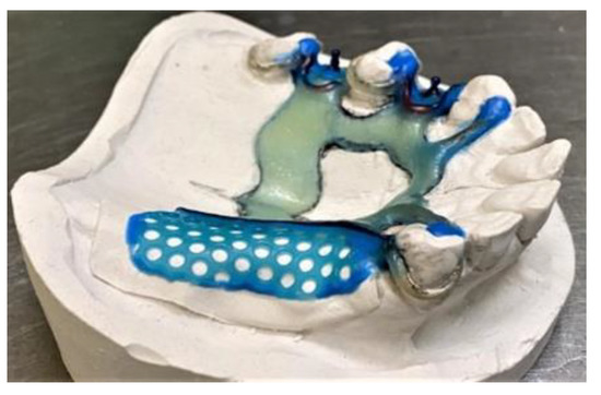 Construction of a Removable Partial Denture (RPD): Comparison between ...