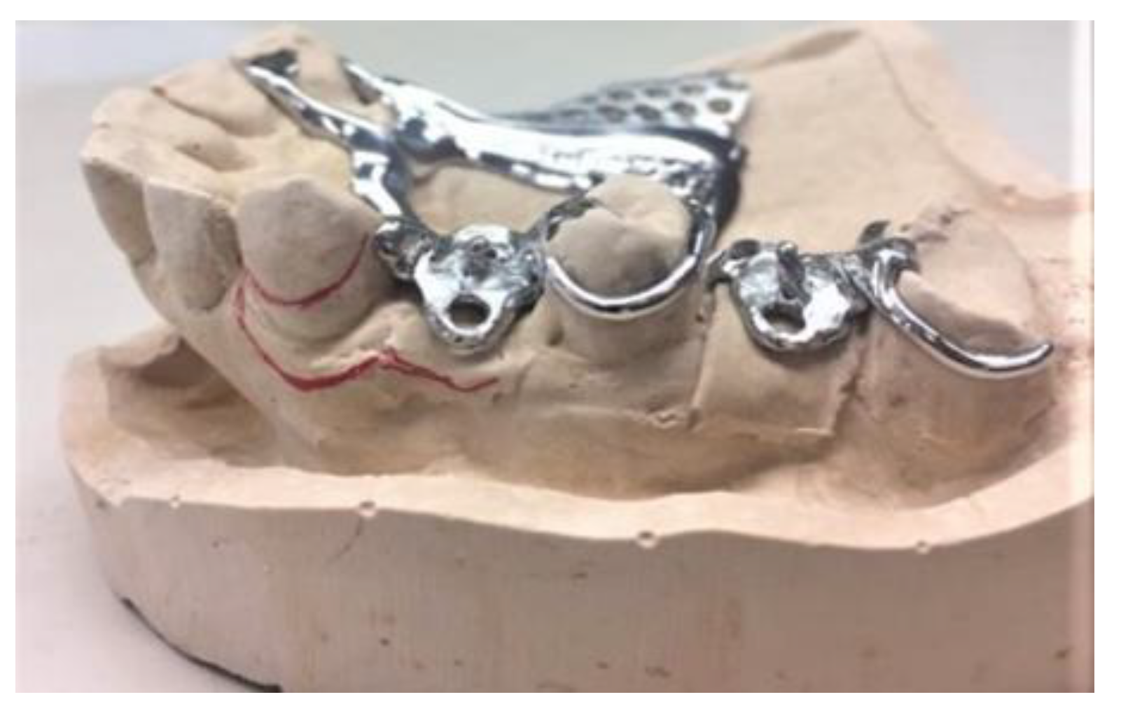 Construction of a Removable Partial Denture (RPD): Comparison between ...