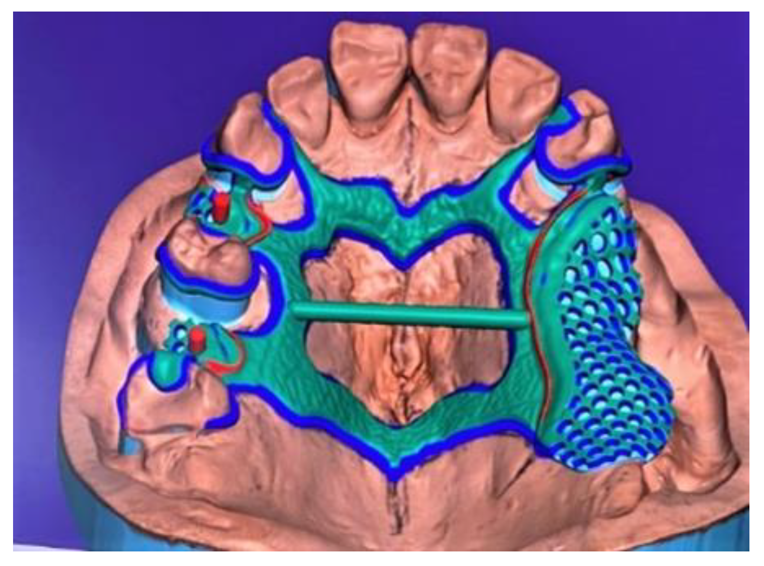 Construction of a Removable Partial Denture (RPD): Comparison between ...