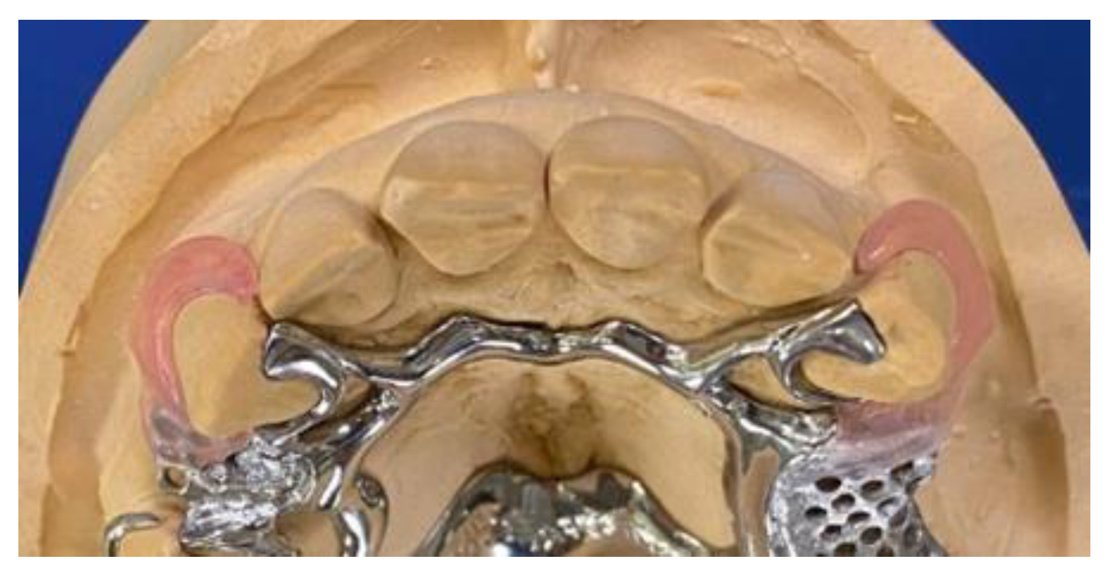 Construction of a Removable Partial Denture (RPD): Comparison between ...