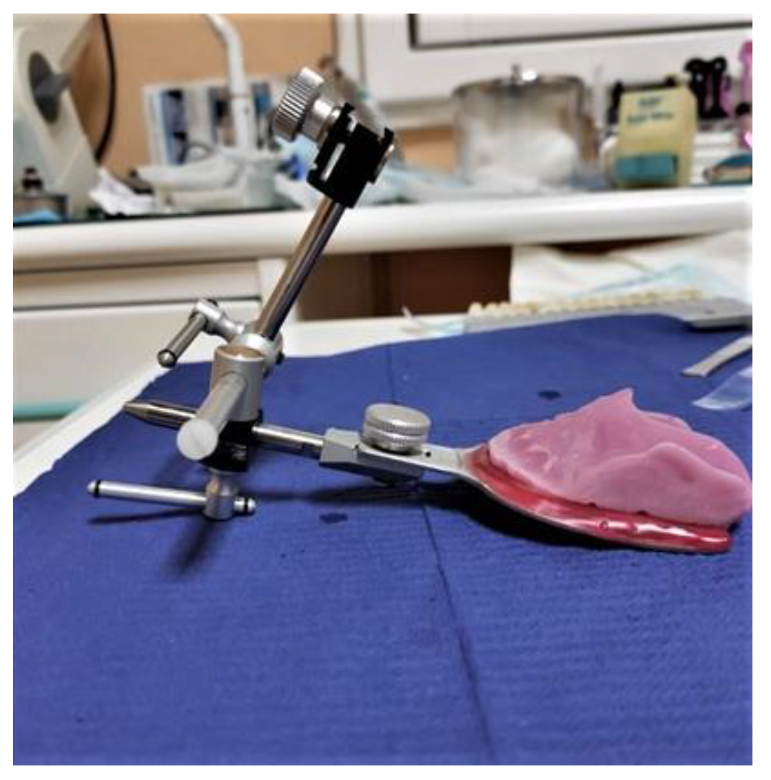 Construction of a Removable Partial Denture (RPD): Comparison between ...