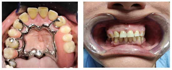 Construction of a Removable Partial Denture (RPD): Comparison between ...