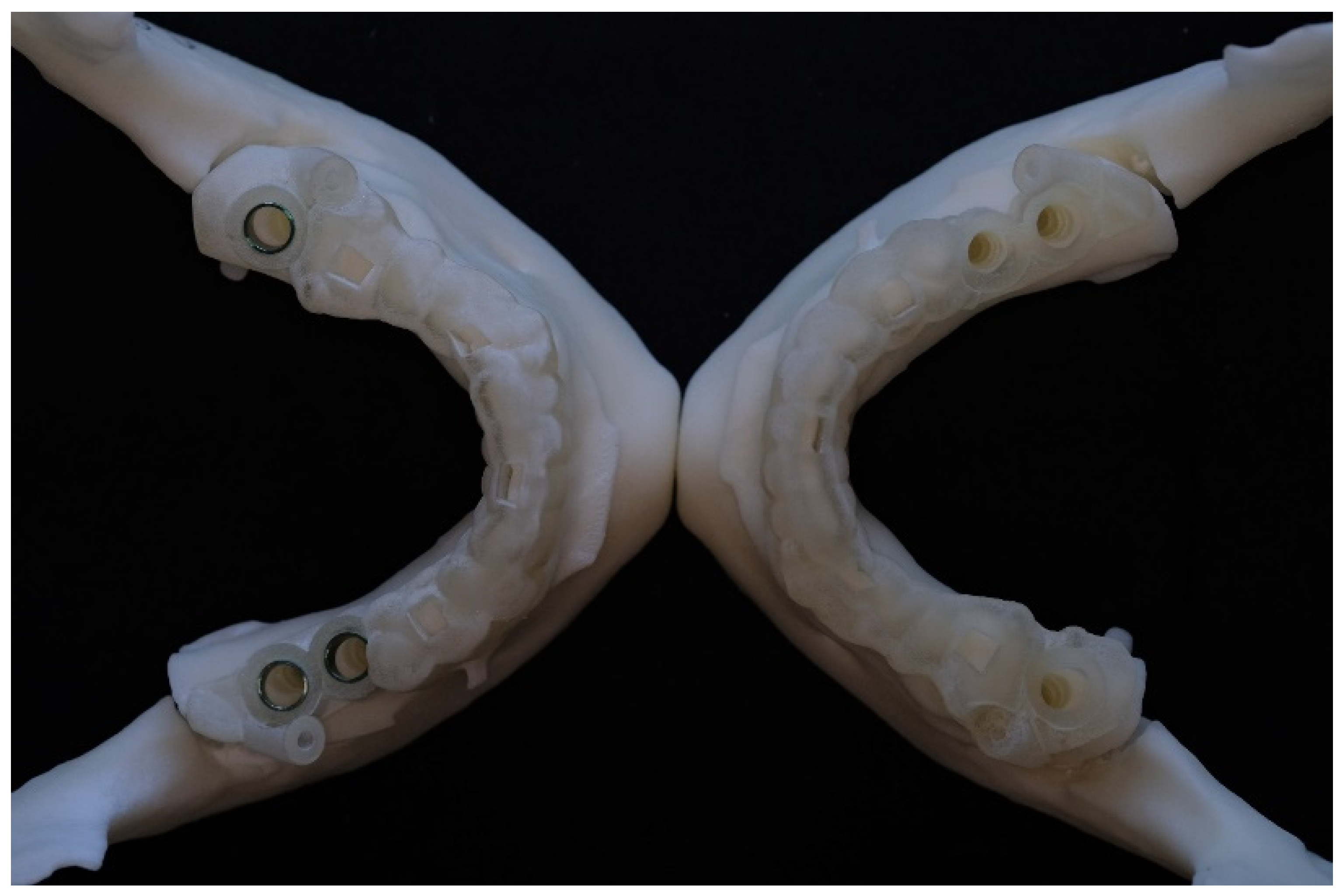 Prosthetic Surgical Templates and Dental Implant Site Time Preparation ...