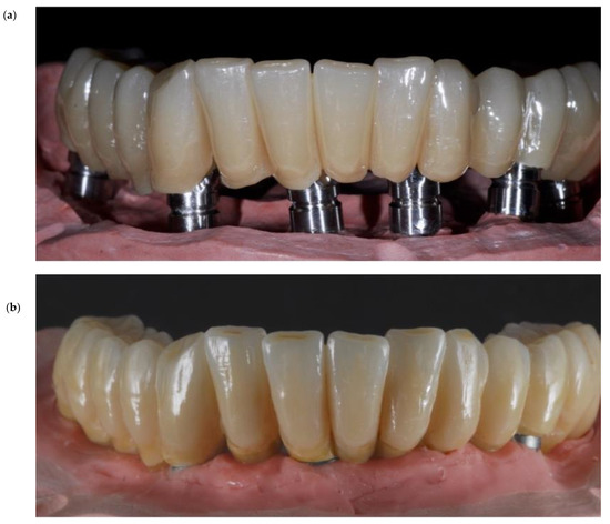 Full-Arch, Implant-Fixed Complete Dentures in Monolithic Zirconia and ...