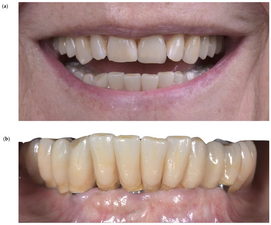 Full-Arch, Implant-Fixed Complete Dentures in Monolithic Zirconia and ...