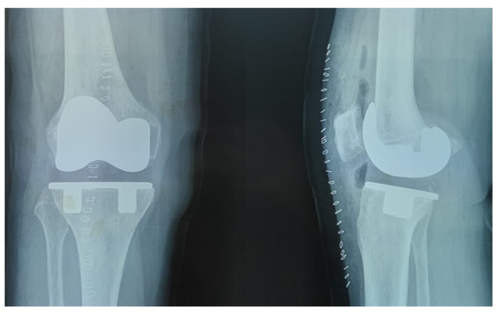 Clinical Results in Posterior-Stabilized Total Knee Arthroplasty with ...