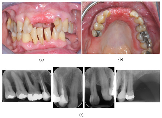 Full Digital Model-Free Maxillary Prosthetic Rehabilitation by Means of ...