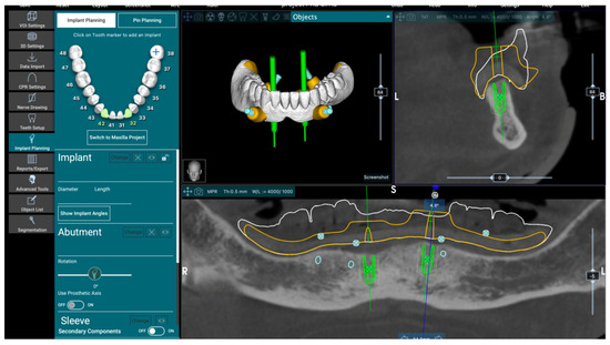 Digital Workflow for Prosthetically Driven Implants Placement and ...