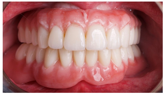 Digital Workflow for Prosthetically Driven Implants Placement and ...