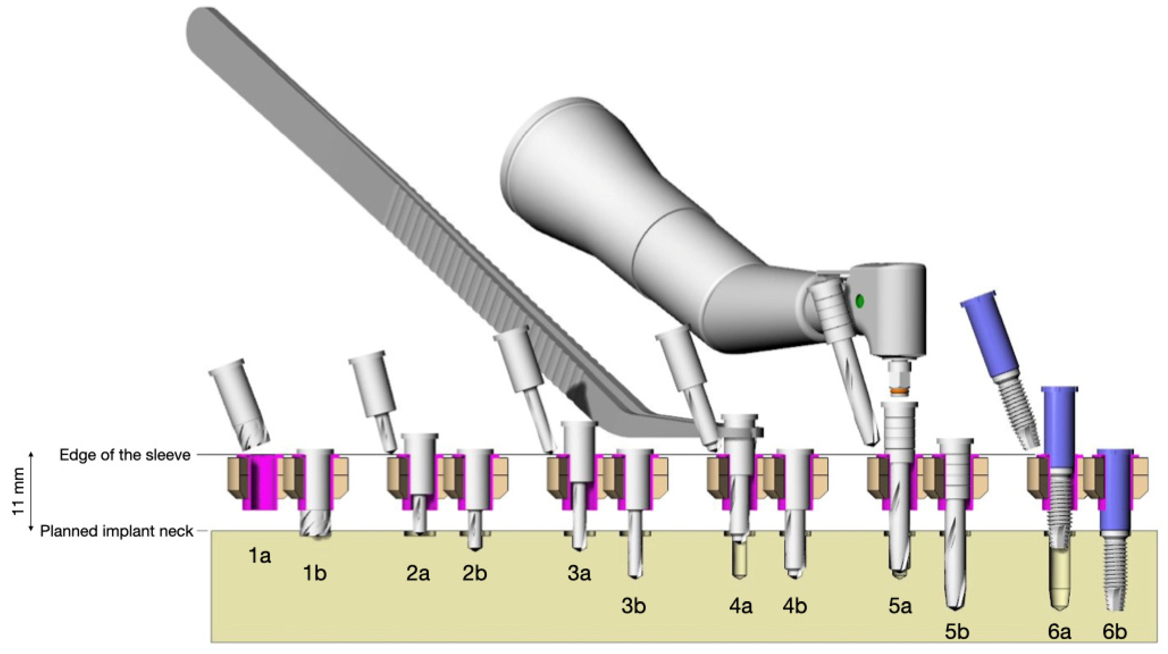 A Novel Approach to Guided Implant Surgery: A Technical Note