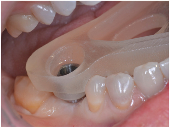 A Novel Approach to Guided Implant Surgery: A Technical Note