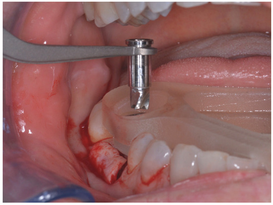 A Novel Approach to Guided Implant Surgery: A Technical Note