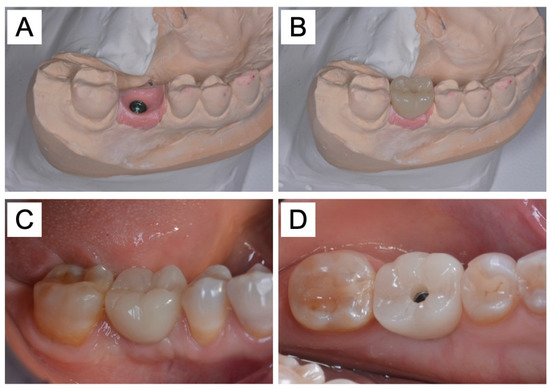 A Novel Approach to Guided Implant Surgery: A Technical Note