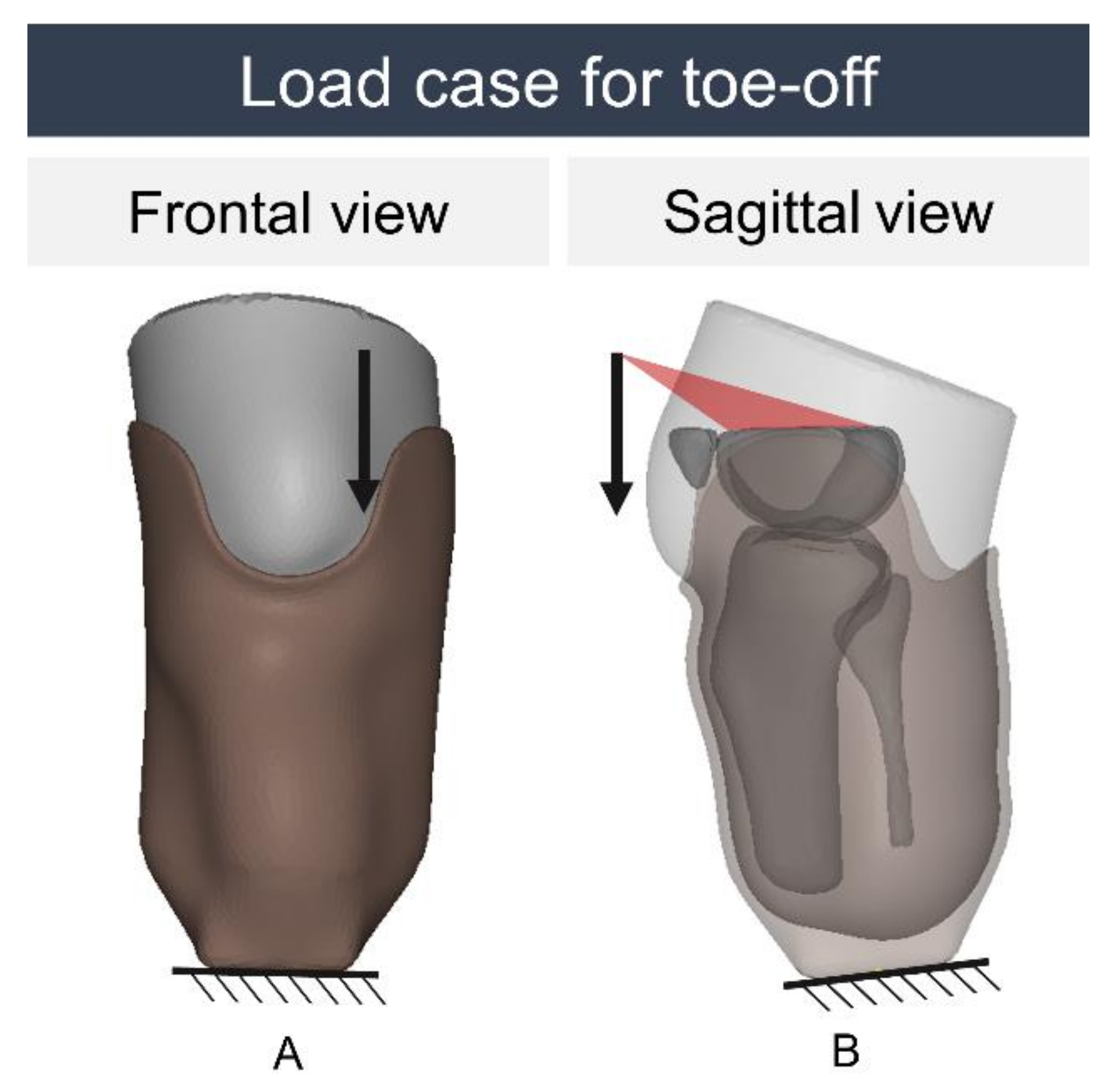 Design Evaluation of FFF-Printed Transtibial Prosthetic Sockets Using Follow-Up and Finite ...