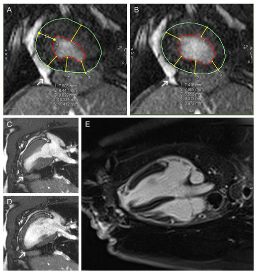 Prosthesis | Free Full-Text | Decellularized Porcine Pericardium ...