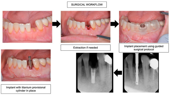 Same-Day Digital Dentistry Restorative Workflow for Single Immediate ...