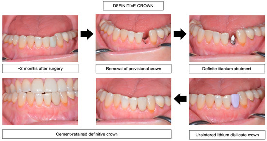 Prosthesis | Free Full-Text | Same-Day Digital Dentistry Restorative Workflow for Single ...