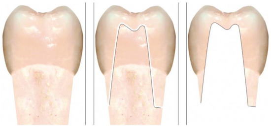 Vertical Edgeless Preparation: Periodontal Dominance in Prosthetic ...