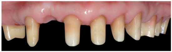 Vertical Edgeless Preparation: Periodontal Dominance in Prosthetic ...