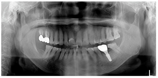 Implant Restoration Using a New Cementless Screw-Retained Type ...