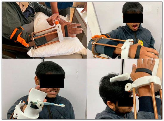 Development and Trial of a Multipurpose Customized Orthosis for ...