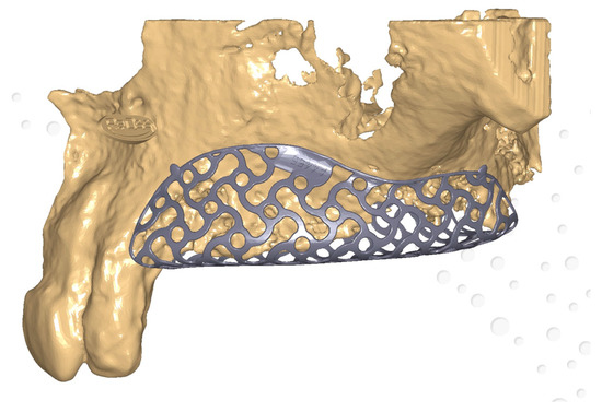 Full-Digital Customized Meshes in Guided Bone Regeneration Procedures: A Scoping Review