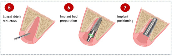 Socket Shield Technique to Improve the Outcomes of Immediate Implant: A Systematic Review and ...