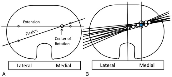 Long-Term Follow-Up of Medial Pivot Total Knee Arthroplasty: A ...