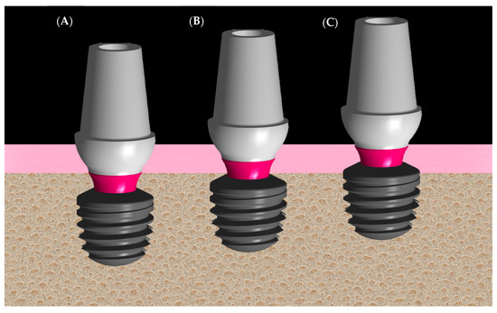 Influence of Placement of Ultrashort Implant at Sub-Crestal, Crestal ...