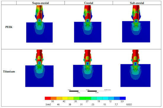 Influence of Placement of Ultrashort Implant at Sub-Crestal, Crestal ...