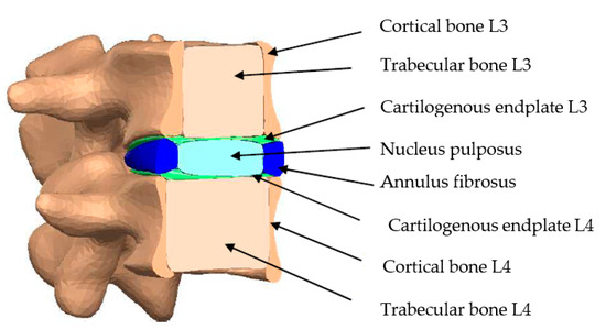 Numerical Assessment of Interspinous Spacers for Lumbar Spine