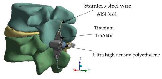 Numerical Assessment of Interspinous Spacers for Lumbar Spine