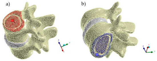Numerical Assessment of Interspinous Spacers for Lumbar Spine