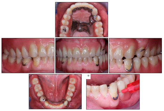 Clinical Protocol for Implant-Assisted Partial Removable Dental ...