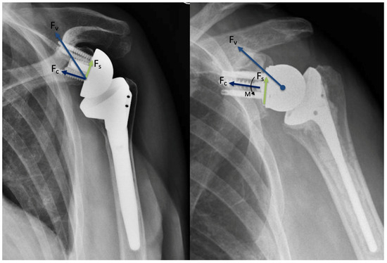 Radiographic Analysis of Grammont-Style and Lateralized Reverse ...