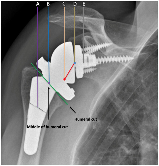 Radiographic Analysis of Grammont-Style and Lateralized Reverse ...