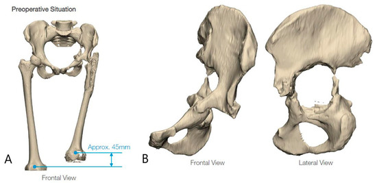 A Combined Use of Custom-Made Partial Pelvic Replacement and Proximal ...