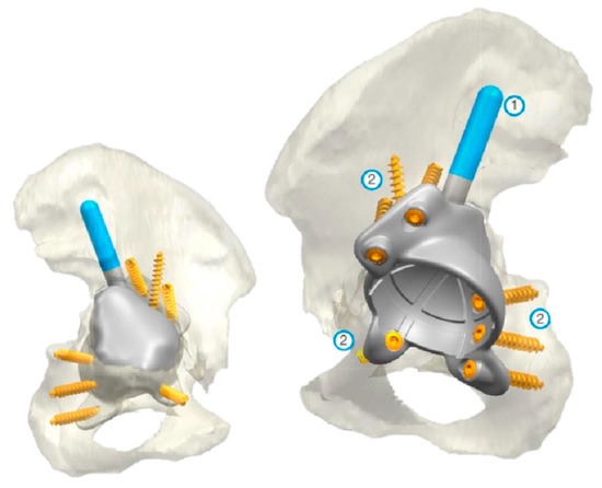 A Combined Use of Custom-Made Partial Pelvic Replacement and Proximal ...