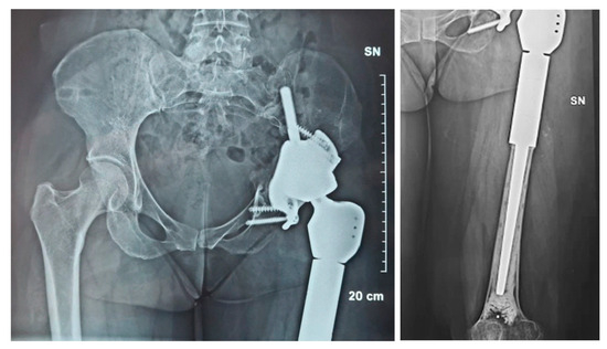 A Combined Use of Custom-Made Partial Pelvic Replacement and Proximal ...