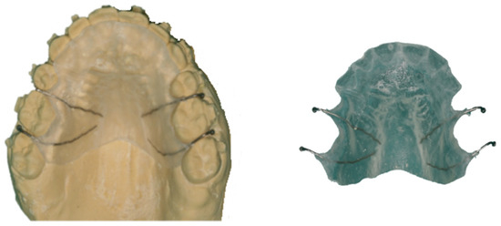 Pharyngeal Obturator Prosthesis Ideal for Orthodontic Appliances: A ...