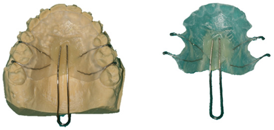 Pharyngeal Obturator Prosthesis Ideal for Orthodontic Appliances: A ...