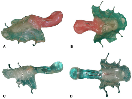 Pharyngeal Obturator Prosthesis Ideal for Orthodontic Appliances: A ...